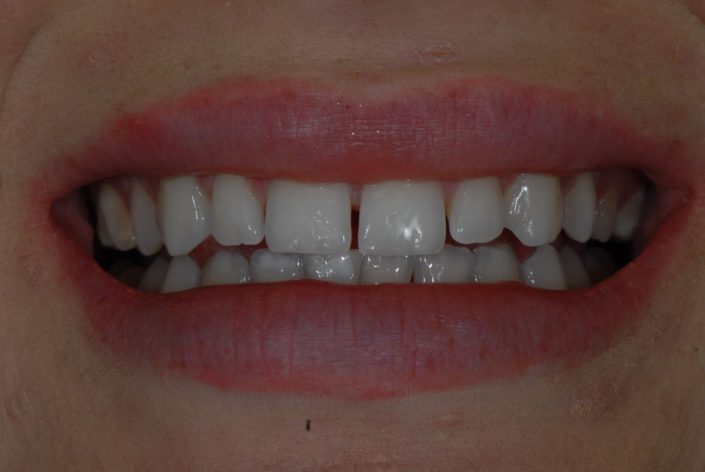 What can I do about the gaps between my teeth? - Dr Martin Jest Dentist